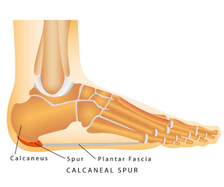 Calcaneal spur - Sree Sree Ayurveda